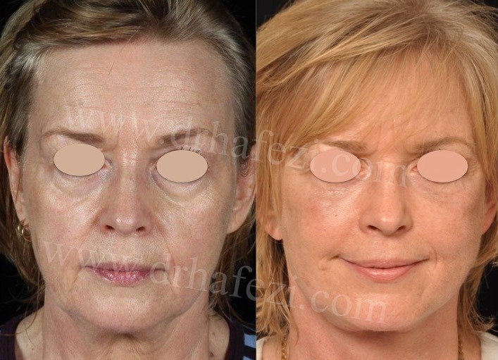 Dr Farhad Hafezi - Facelift before and After Samples - Iran Medical Visa