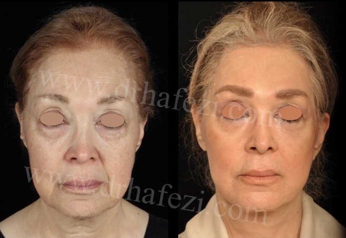 Dr Farhad Hafezi - Facelift before and After Samples - Iran Medical Visa
