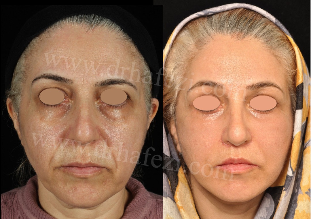 Dr Farhad Hafezi - Facelift before and After Samples - Iran Medical Visa
