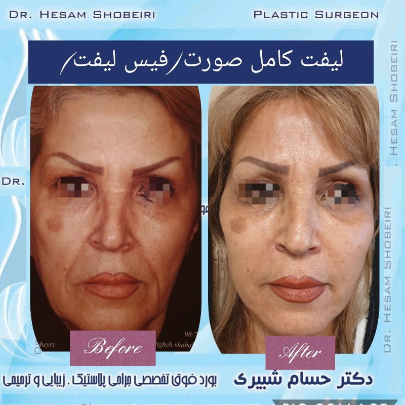 Dr Hessam Shobeiri - Facelift before and After Samples - Iran Medical Visa