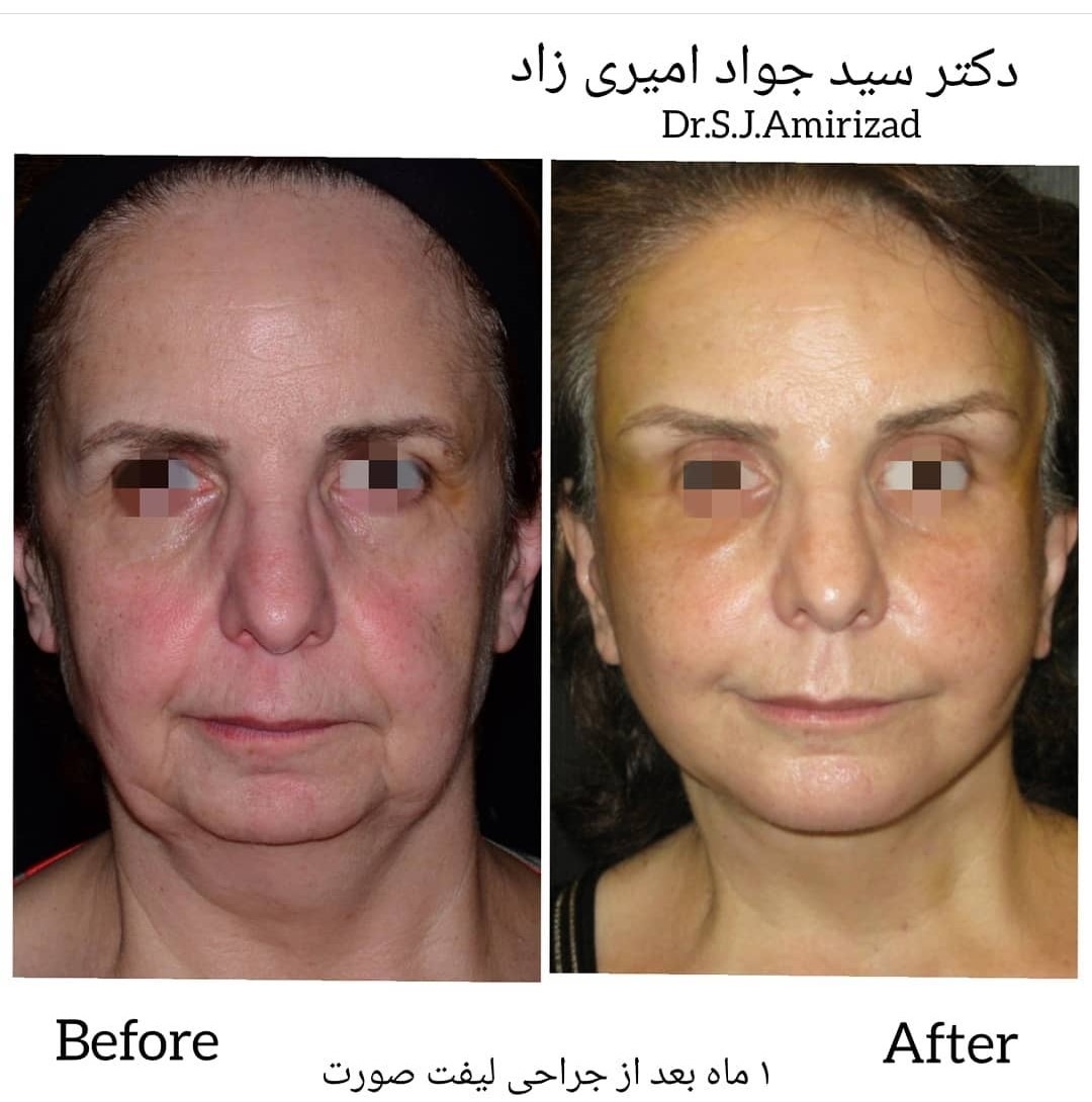 Dr Amiri zad - Facelift before and After Samples - Iran Medical Visa