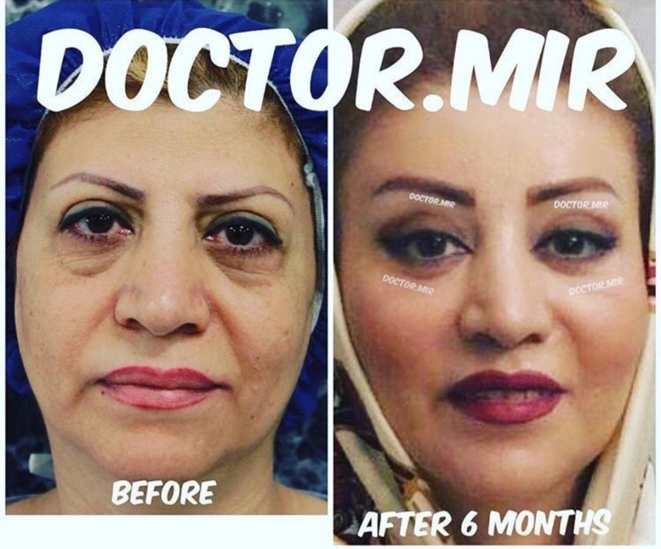 Dr Mir Mohamad Mehdi - Facelift before and After Samples - Iran Medical Visa