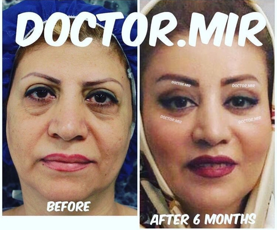 Dr Mir Mohamad Mehdi - Facelift before and After Samples - Iran Medical ...