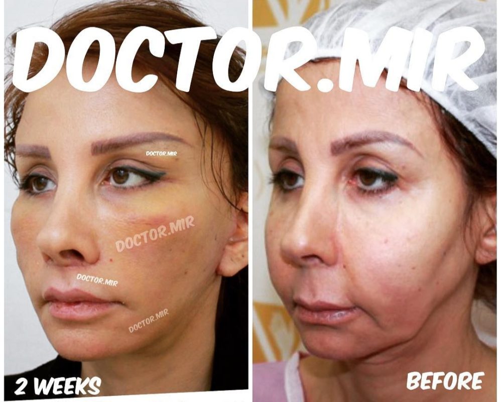 Dr Mir Mohamad Mehdi - Facelift before and After Samples - Iran Medical ...