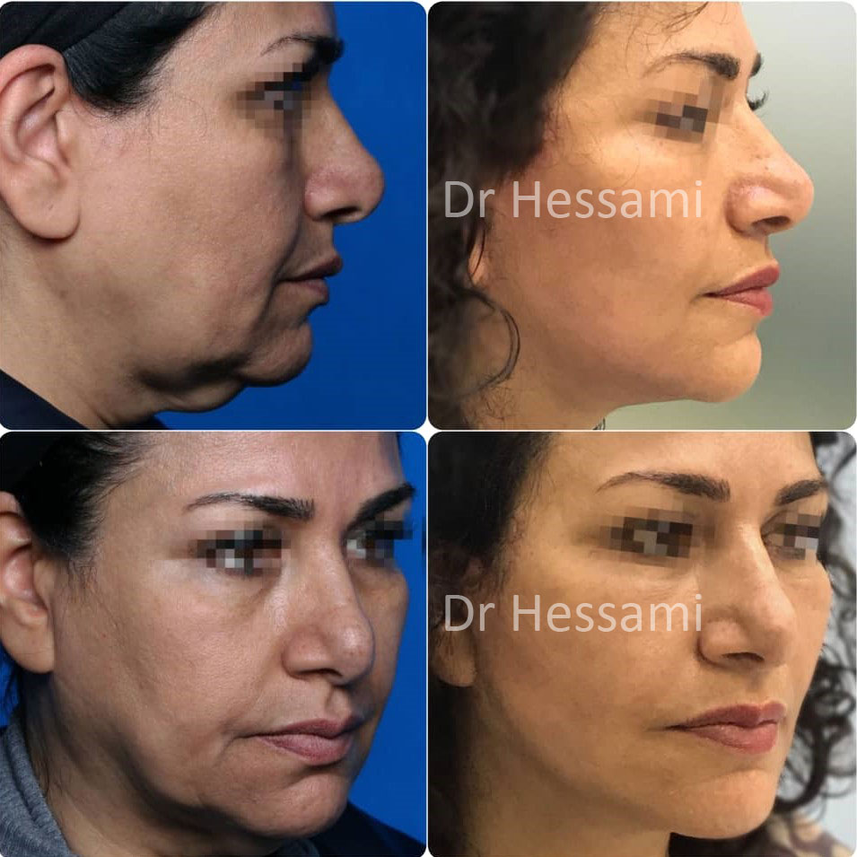 Dr Reza Hessami - Facelift before and After Samples - Iran Medical Visa
